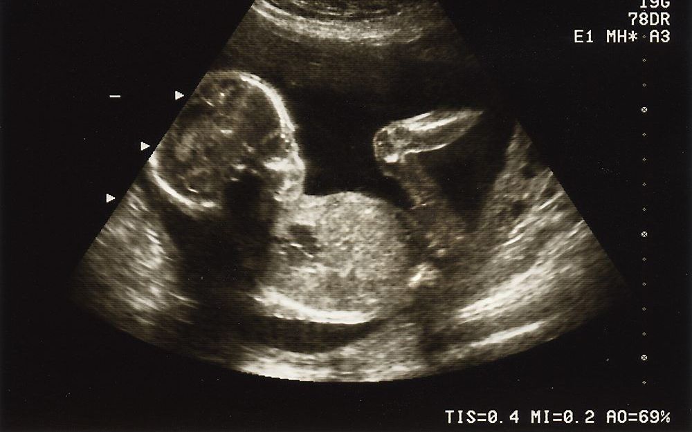 Twijfel na abortus vanwege open ruggetje