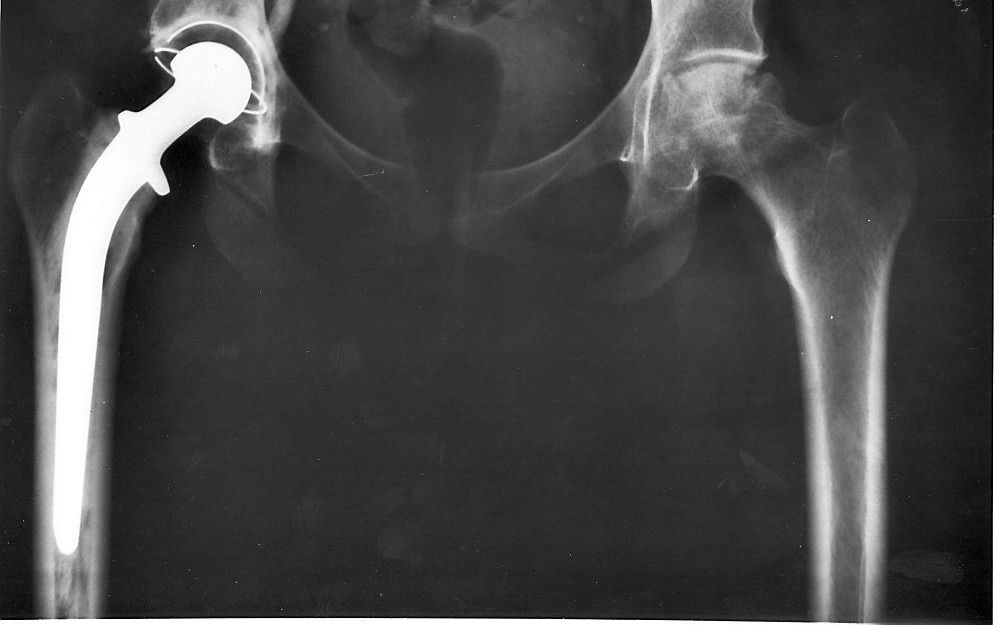 Betere behandeling voor heupbreuk