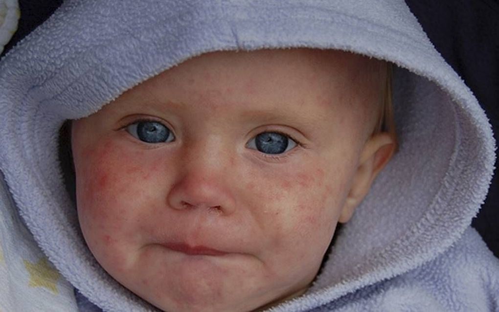 Mazelen en rodehond breiden verder uit