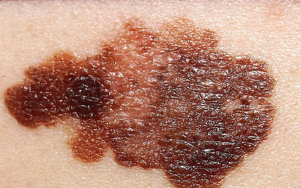 Gratis huidkankercheck op 30 mei