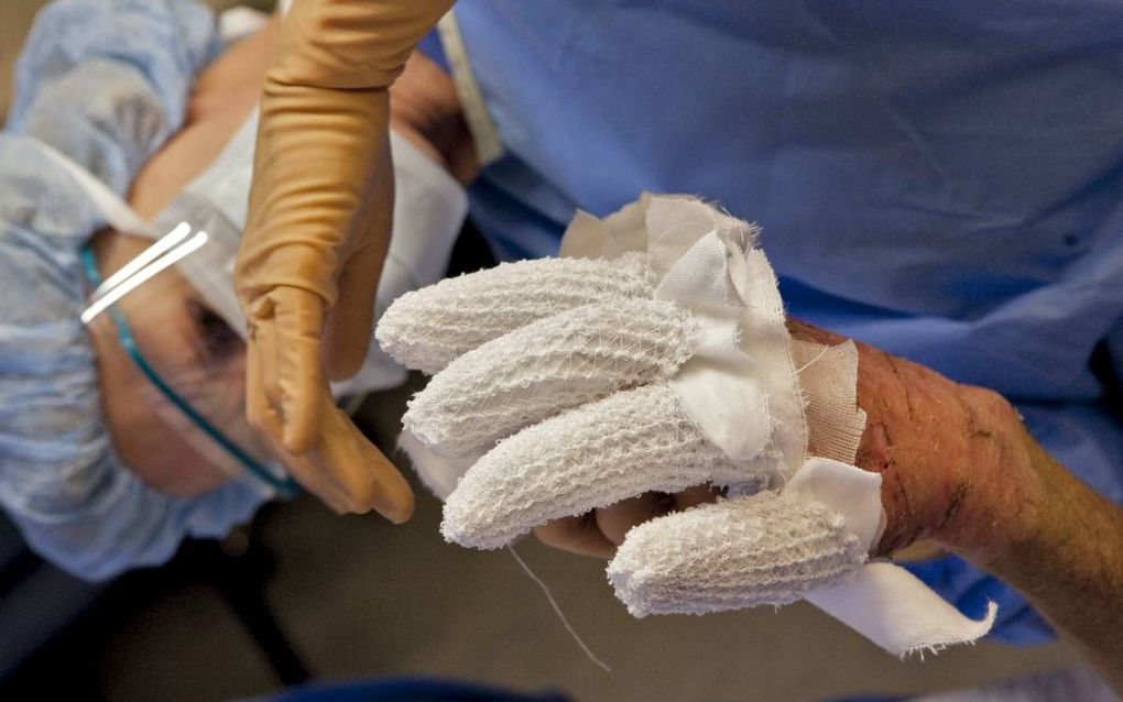 Brandwond behandelen met eigen speeksel