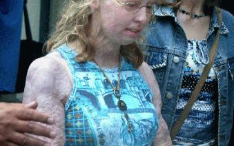 Cafébrand in Volendam was niet te blussen