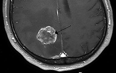 Hypericine uit sint-janskruid remt groei hersentumor