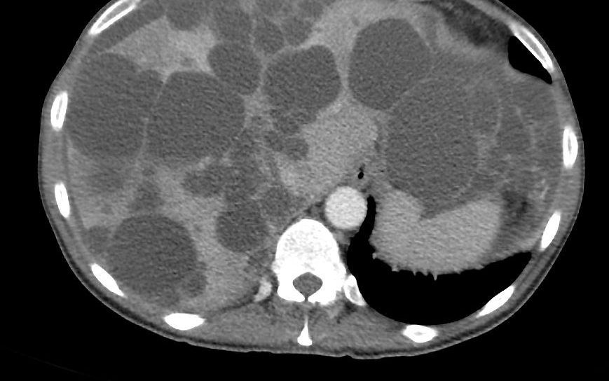Lever vol vochtblazen bij polycysteuze leverziekte